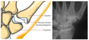 Daumensattelgelenkarthrose (Rhizarthrose)