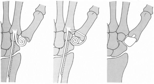 Daumensattelgelenkarthrose (Rhizarthrose)