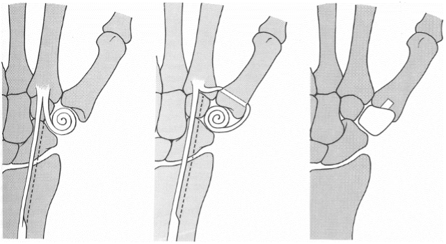 Daumensattelgelenkarthrose (Rhizarthrose)